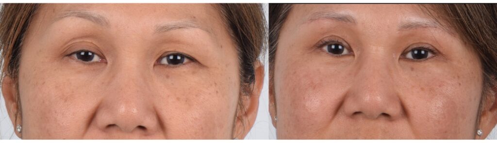 Ptosis Surgery Los Angeles | Droopy Eyelid Correction